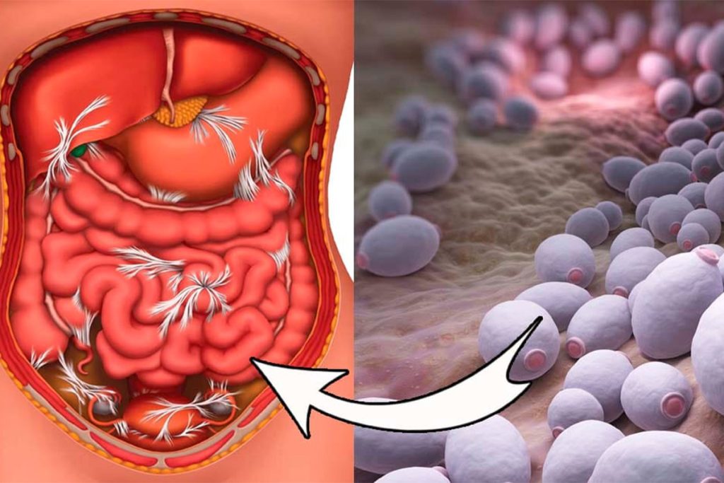 Θεραπεία CANDIDA | Τerrapapers